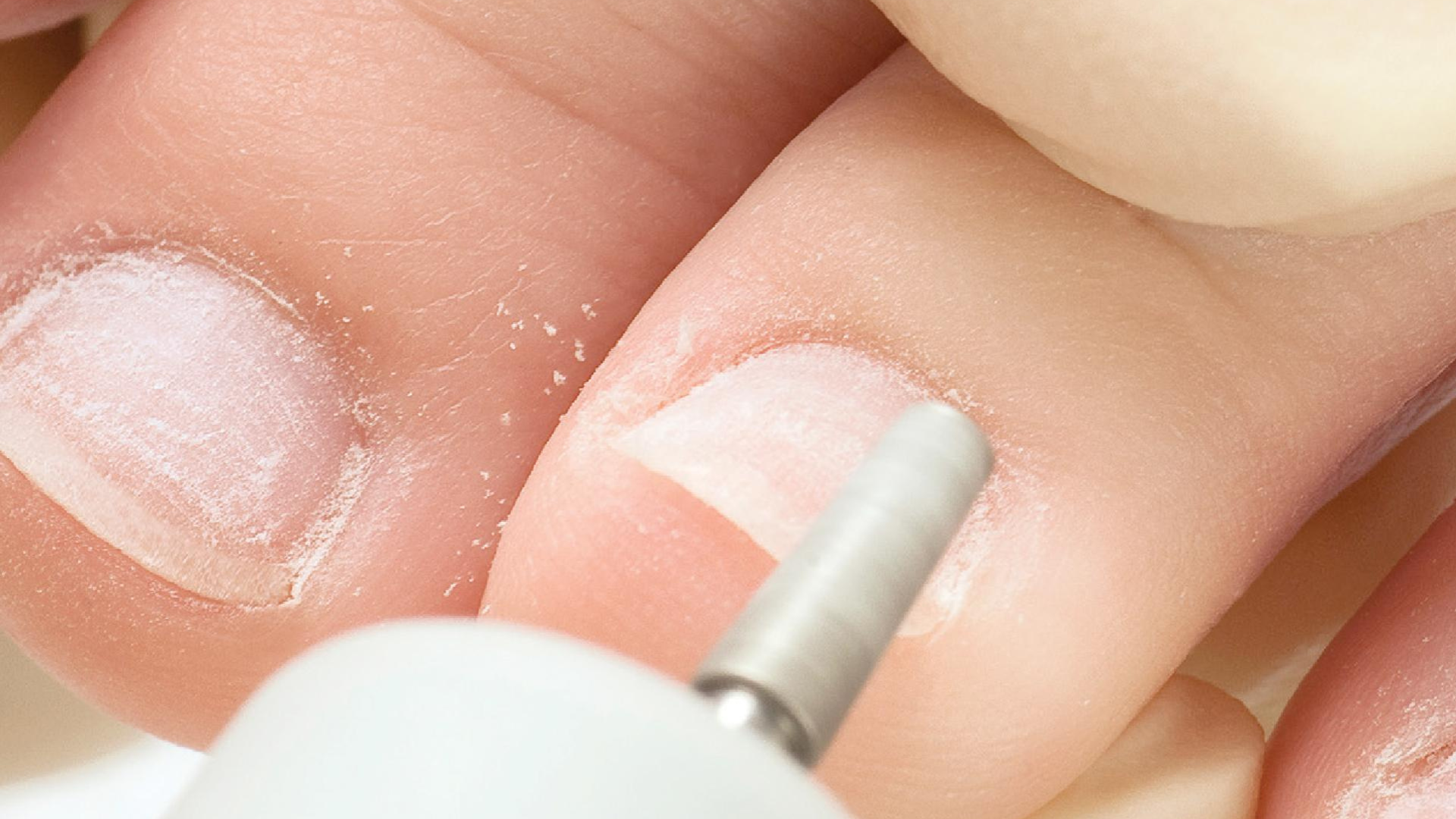 LCN Wilde Pedique Toenail Reconstruction Training (FHPs & Podiatrists ...